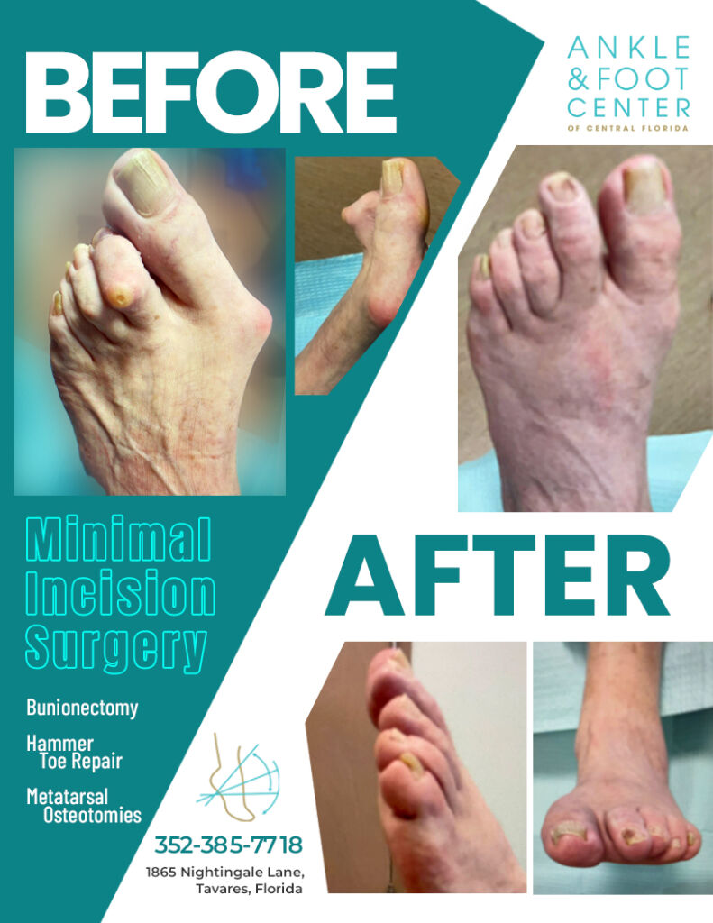 Ankle and Foot Center of Central Florida – Ankle & Foot Surgeon